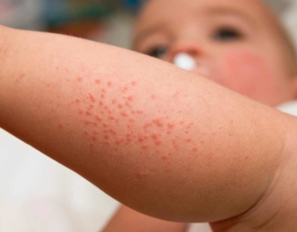 7 Common Childhood Rashes | Health | Kidspot
